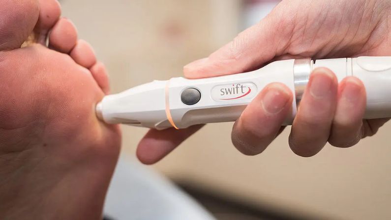 SWIFT Microwave Therapy: Treatment For Warts At AC Podiatry | AC Podiatry